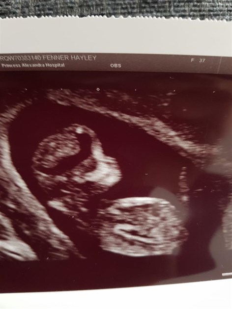 Daniel Fenner is fundraising for Tommy’s, the pregnancy and baby charity