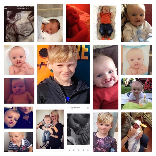 Emma Heatley is fundraising for Cleft Lip And Palate Association