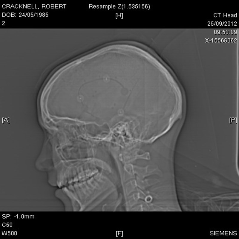 Robert Cracknell is fundraising for Brainkind