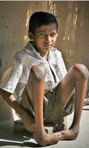 Beth Capper is fundraising for Global Clubfoot Initiative