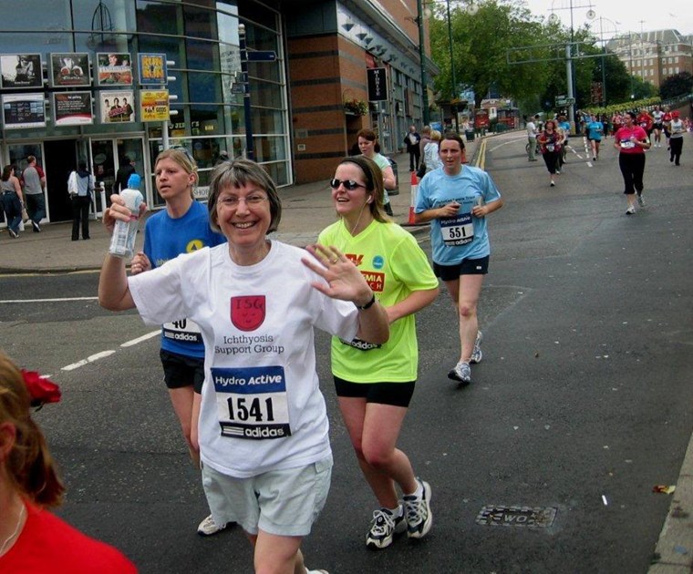 Robin Ferner is fundraising for Ichthyosis Support Group