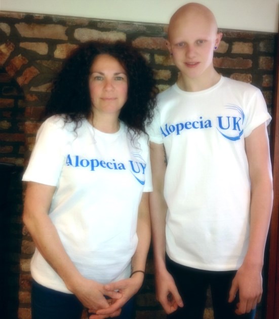 Sally Halliday is fundraising for Alopecia UK