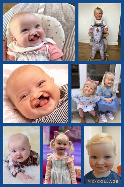 Sarah Woolner is fundraising for Cleft Lip And Palate Association