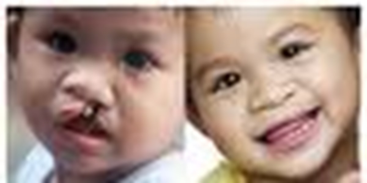Chloe Pope is fundraising for Operation Smile United Kingdom