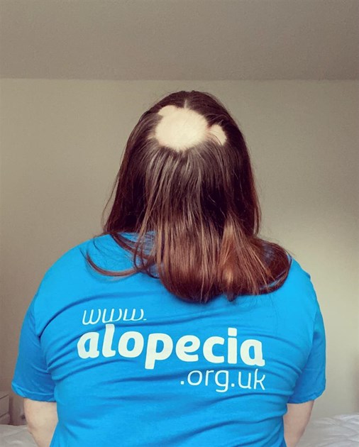Abbie Jarvis is fundraising for Alopecia UK