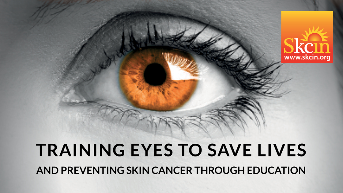 Lauren Smith is fundraising for SKCIN - The Karen Clifford Skin Cancer ...
