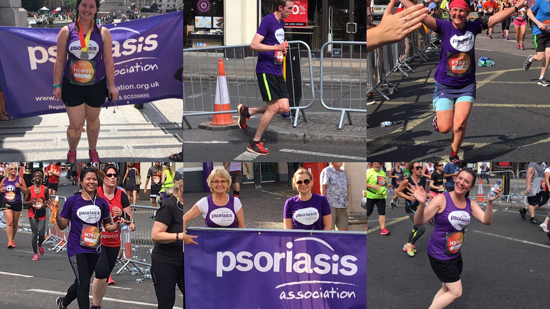 Matthew Goddin is fundraising for The Psoriasis Association