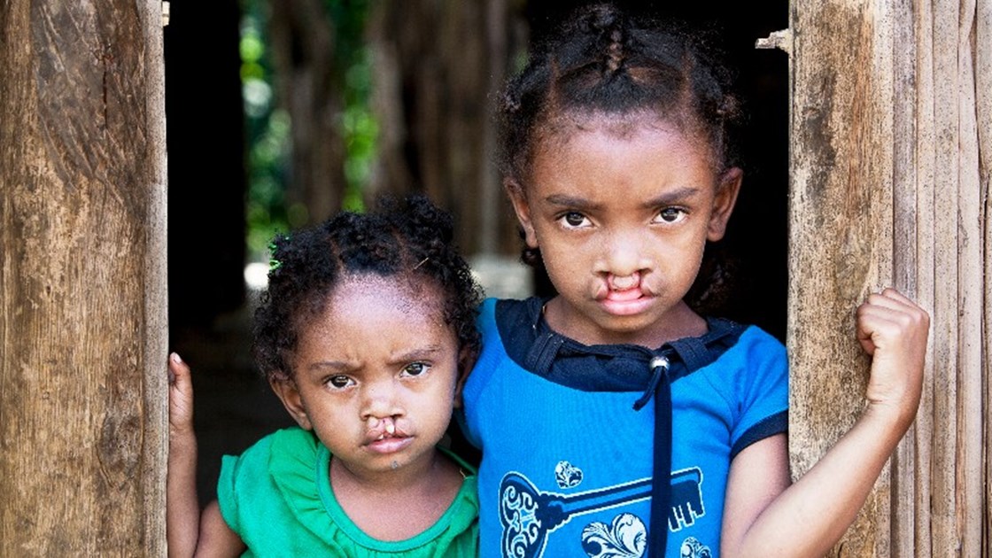 Bas van velzen is fundraising for Operation Smile United Kingdom