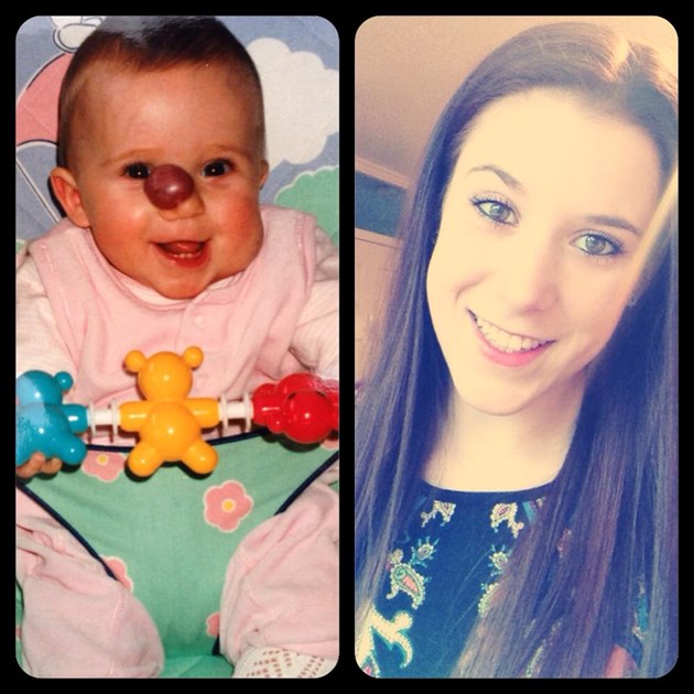 Jenna Sendall is fundraising for Birthmark Support Group