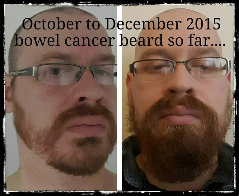 George Howie Is Fundraising For Beating Bowel Cancer